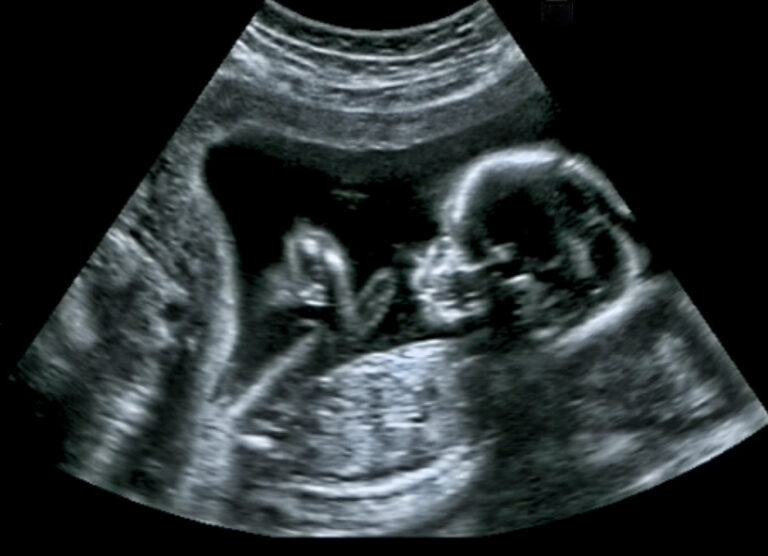 Developing a ‘bedside’ test for reassurance of fetal wellbeing in the ...